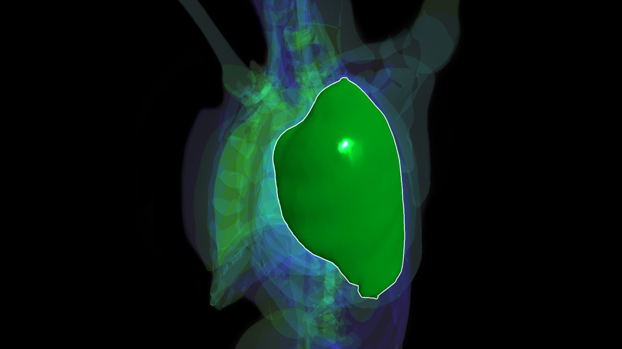 RaySearch Delivers AI-Powered Oncology With NVIDIA GPUs | NVIDIA ...